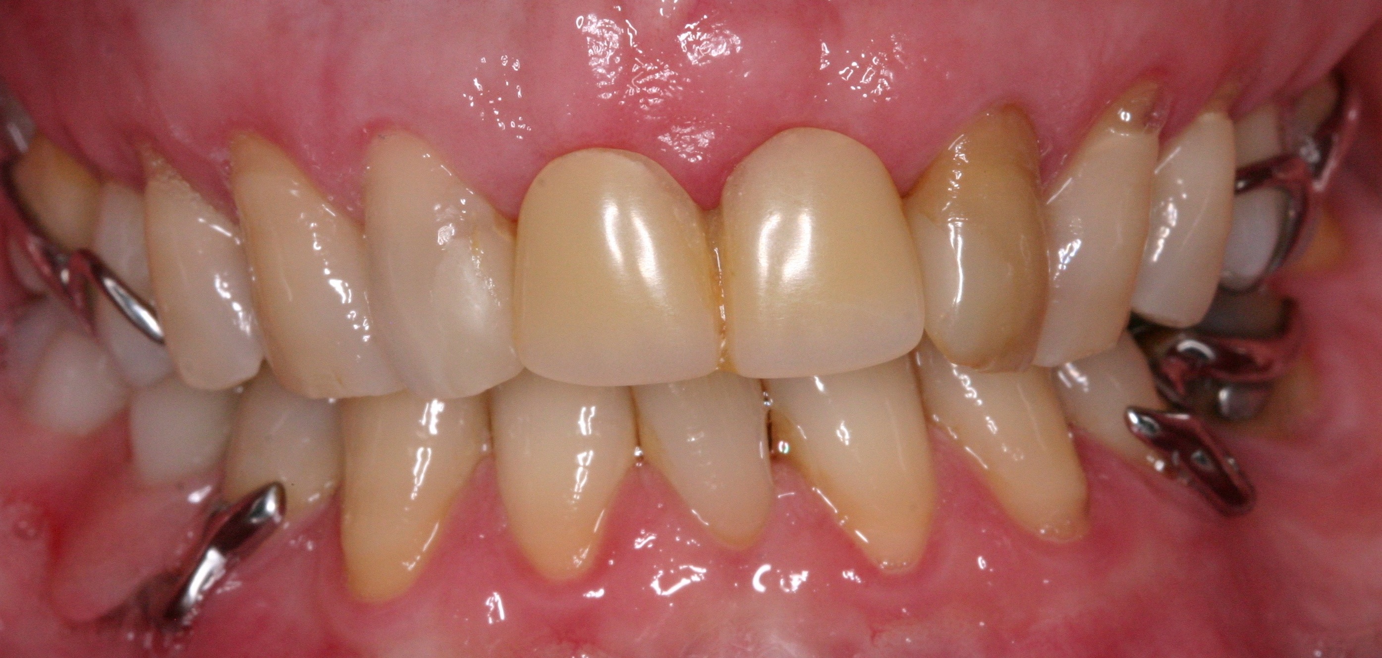 Prótese adesiva em resina composta reforçada por fibra de vidro : Surya ...