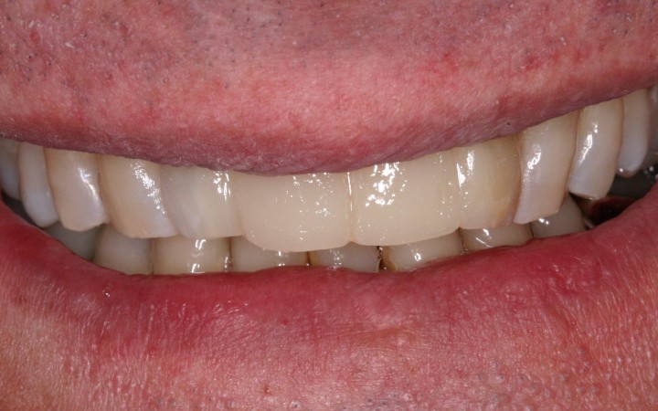 Prótese adesiva em resina composta reforçada por fibra de vidro