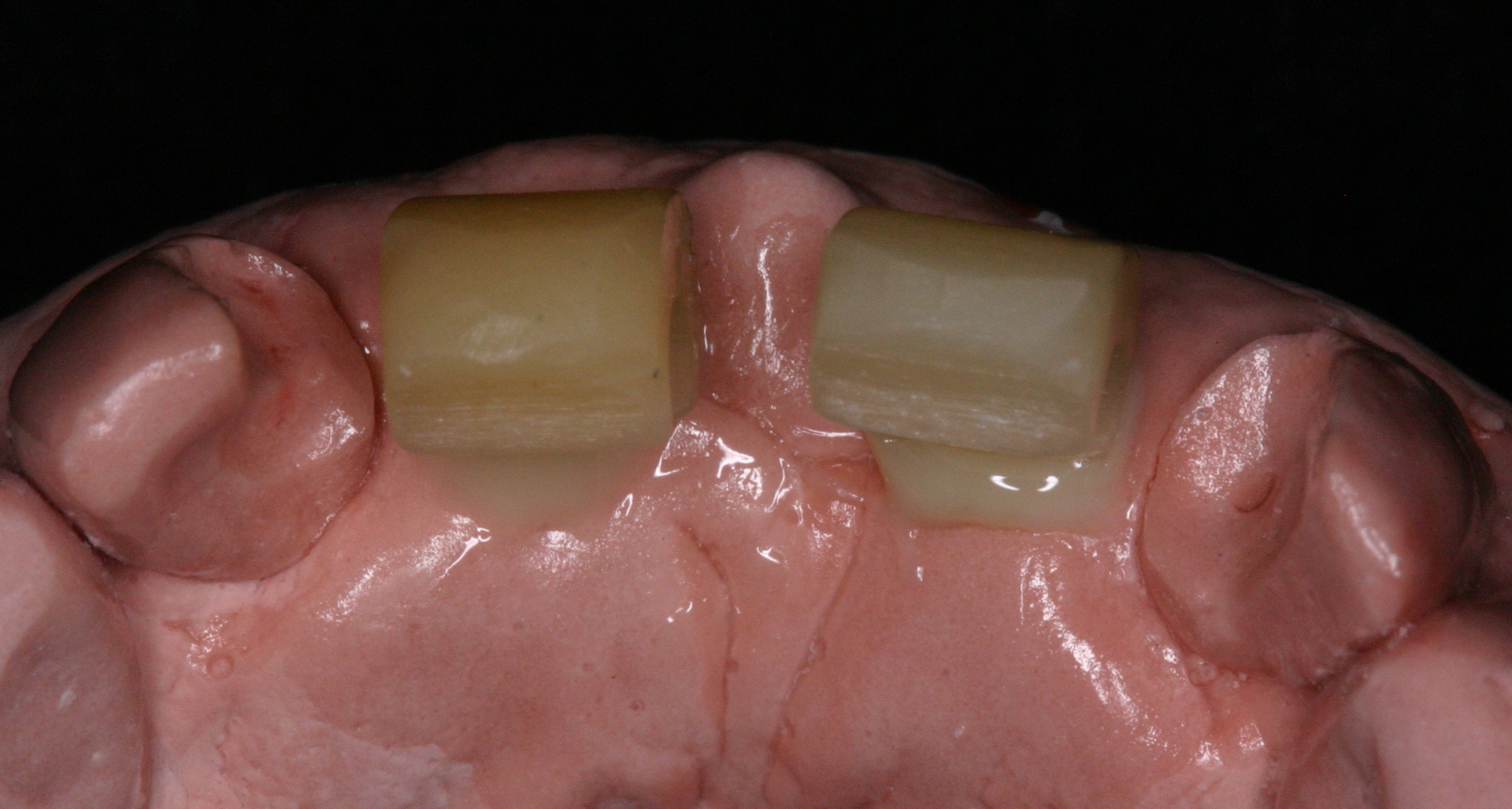 Prótese adesiva em resina composta reforçada por fibra de vidro