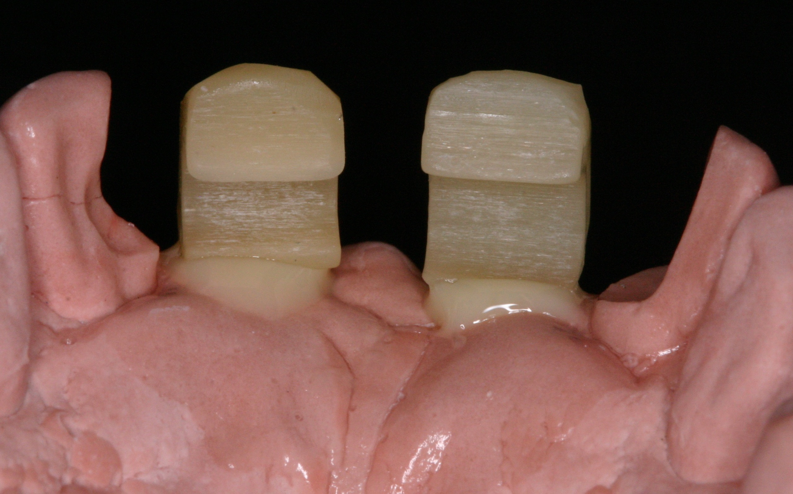 Prótese adesiva em resina composta reforçada por fibra de vidro : Surya ...