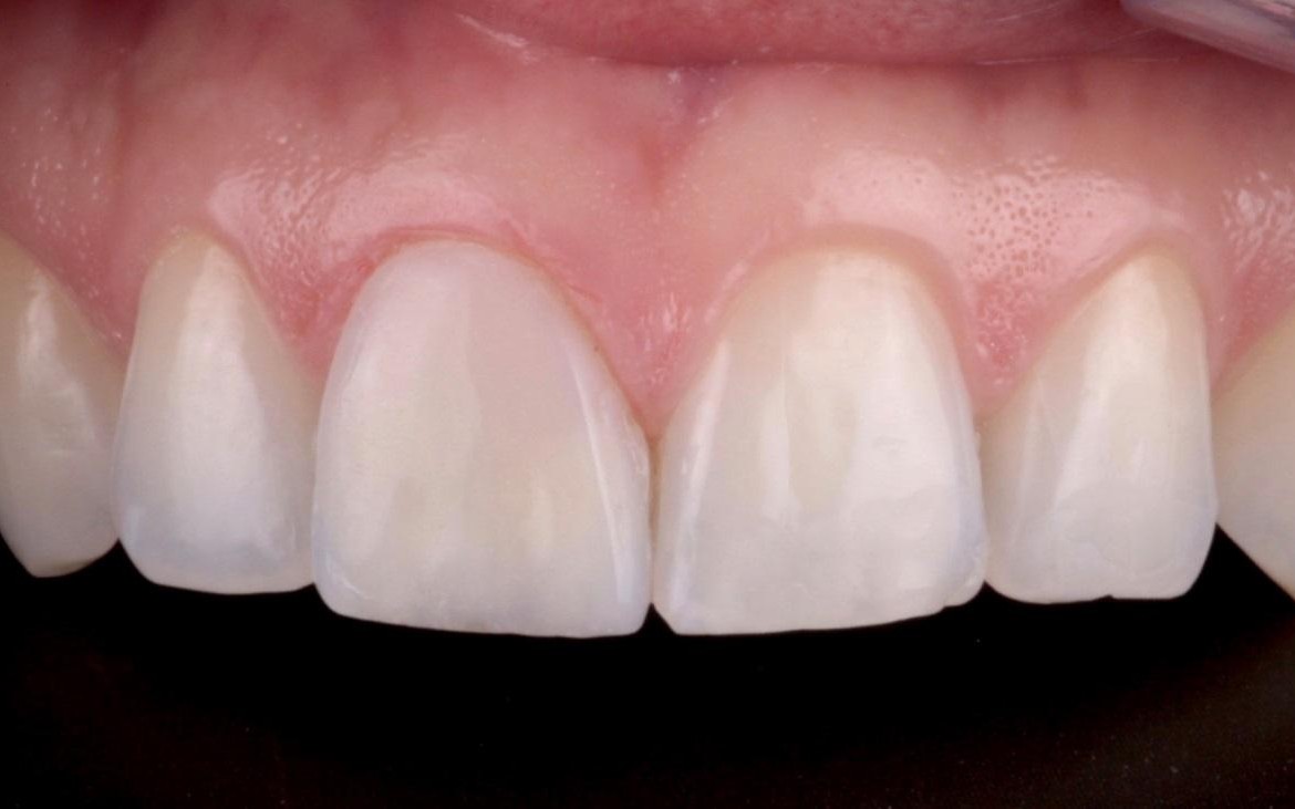 Restabelecendo estética e função em um incisivo central escurecido ...