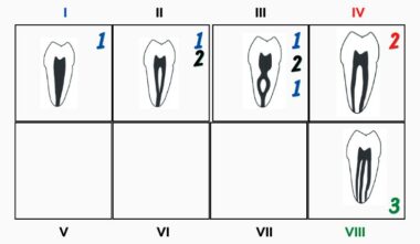 Dúvidas sobre a classificação de Vertucci? Entenda mais!