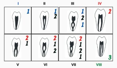 Dúvidas sobre a classificação de Vertucci? Entenda mais!